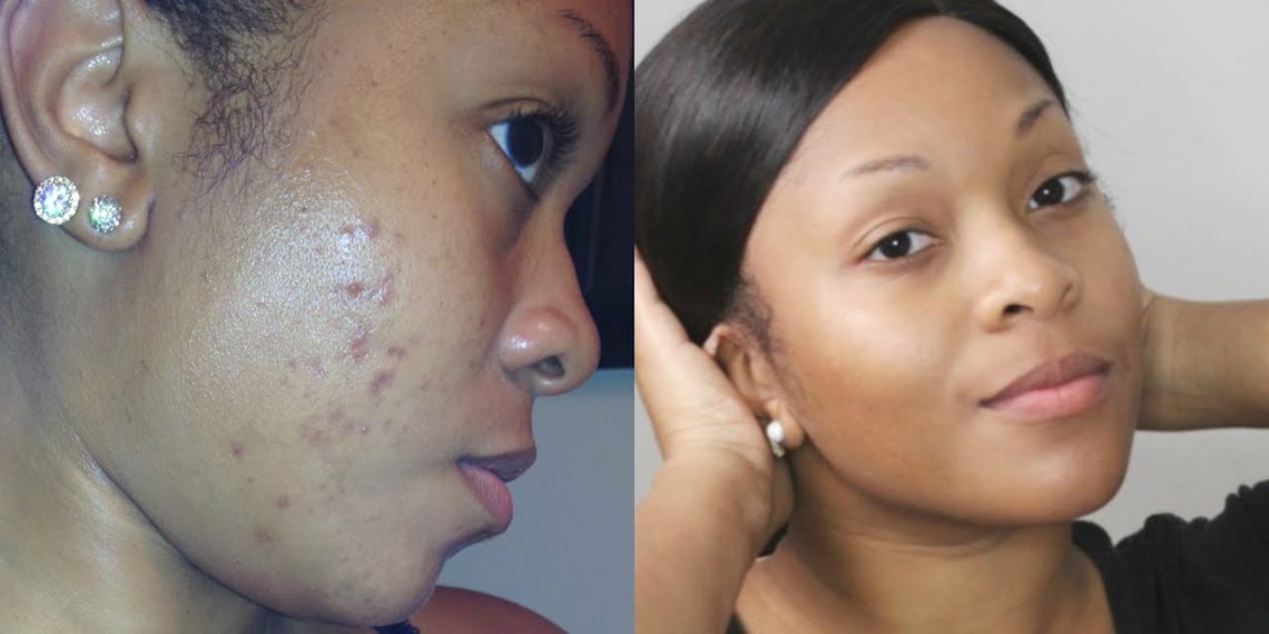 Face Picking: How To Stop Touching Your Face – Rededit Magazine